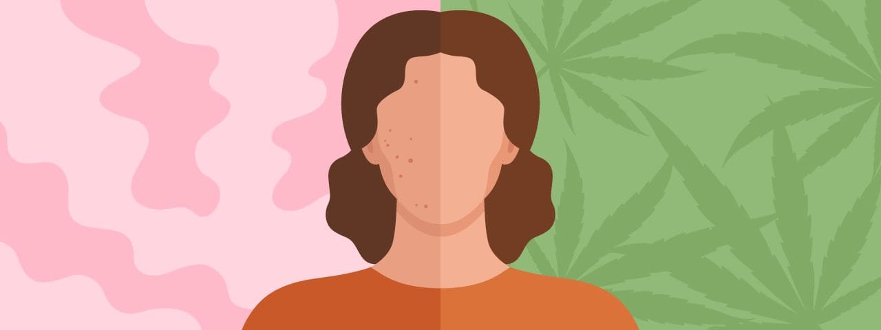 Does smoking weed cause acne? Cannabis and skin health explained